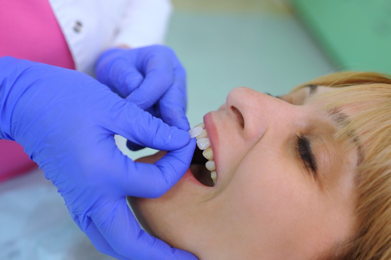 The Evolution of Dental Veneers, from 1928 to Now - Fisher Dental Blog